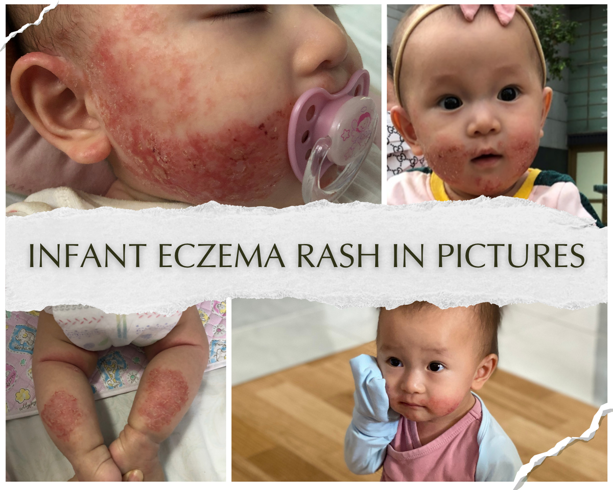 Baby Eczema Rash in Pictures – Little Warriors SG